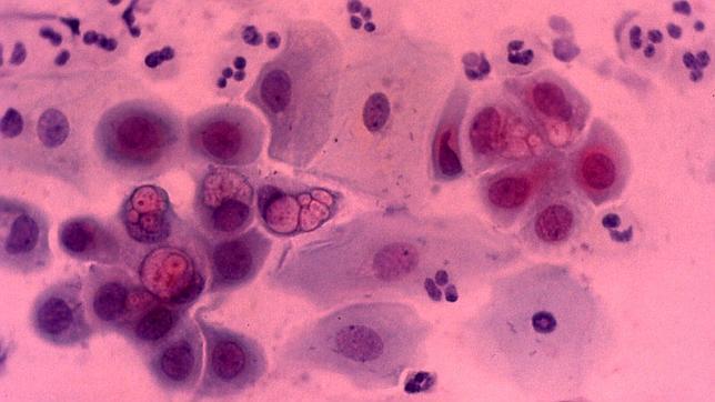 Las enfermedades de transmisión sexual más frecuentes