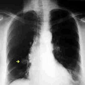 ¿Qué es un nódulo pulmonar?