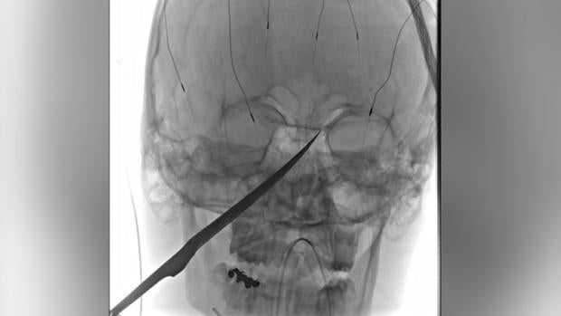Extraen con éxito un cuchillo de 25 centímetros que había perforado la ...